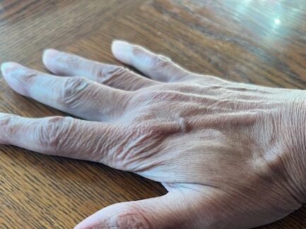 Treating Stenosing Tenosynovitis (Trigger Finger) with Shockwave ...