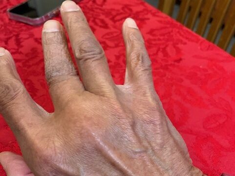 Treating Stenosing Tenosynovitis (Trigger Finger) with Shockwave ...